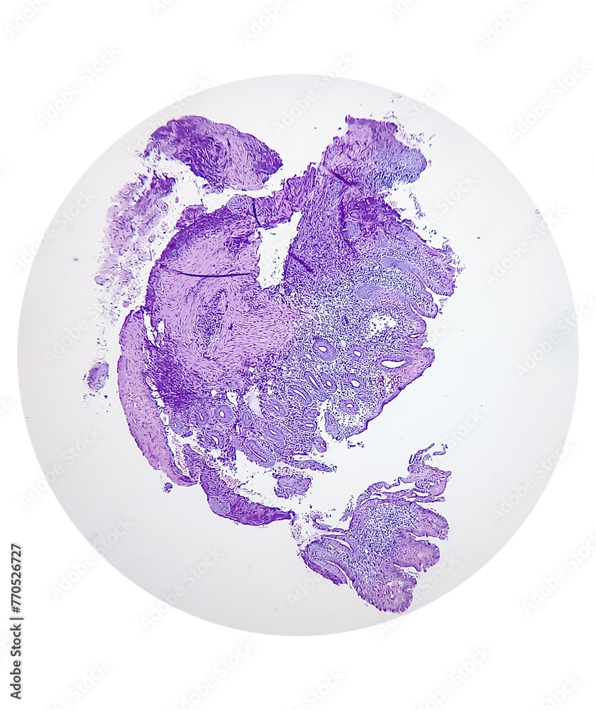 Sigmoid colon (colonoscopic biopsy): Chronic nonspecific colitis. Show ...
