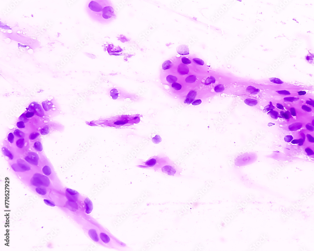 Light micrograph of a vaginal smear showing adenocarcinoma cells ...