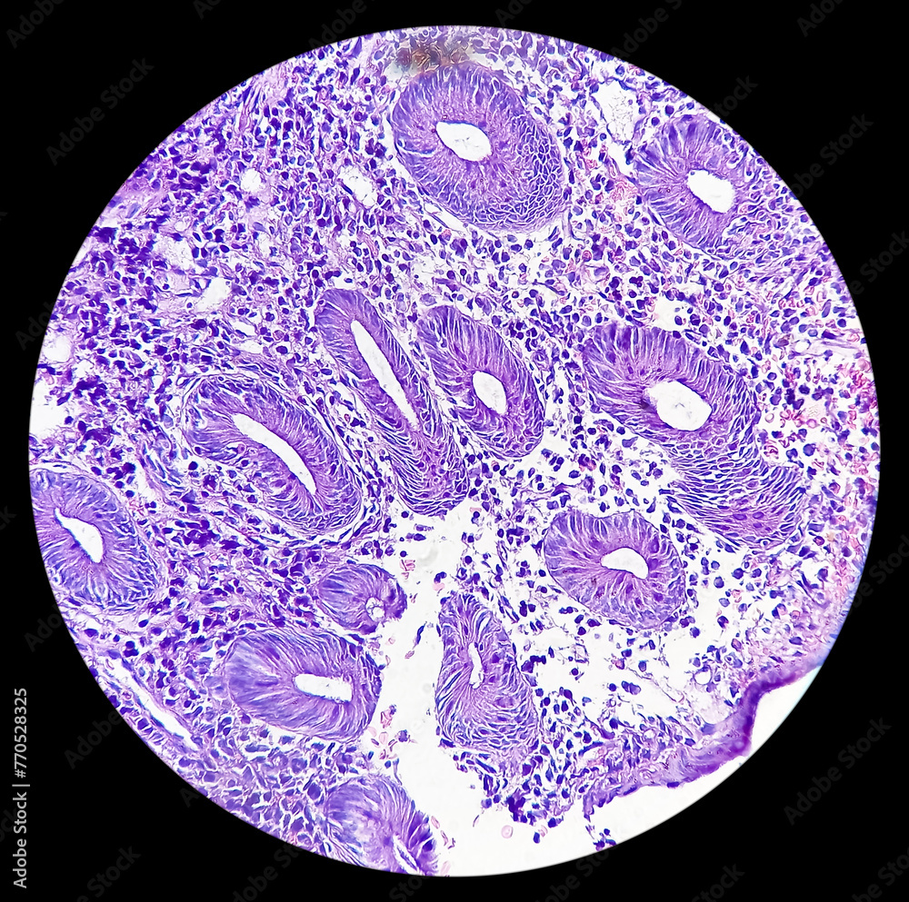 Sigmoid colon (colonoscopic biopsy): Chronic nonspecific colitis. Show ...