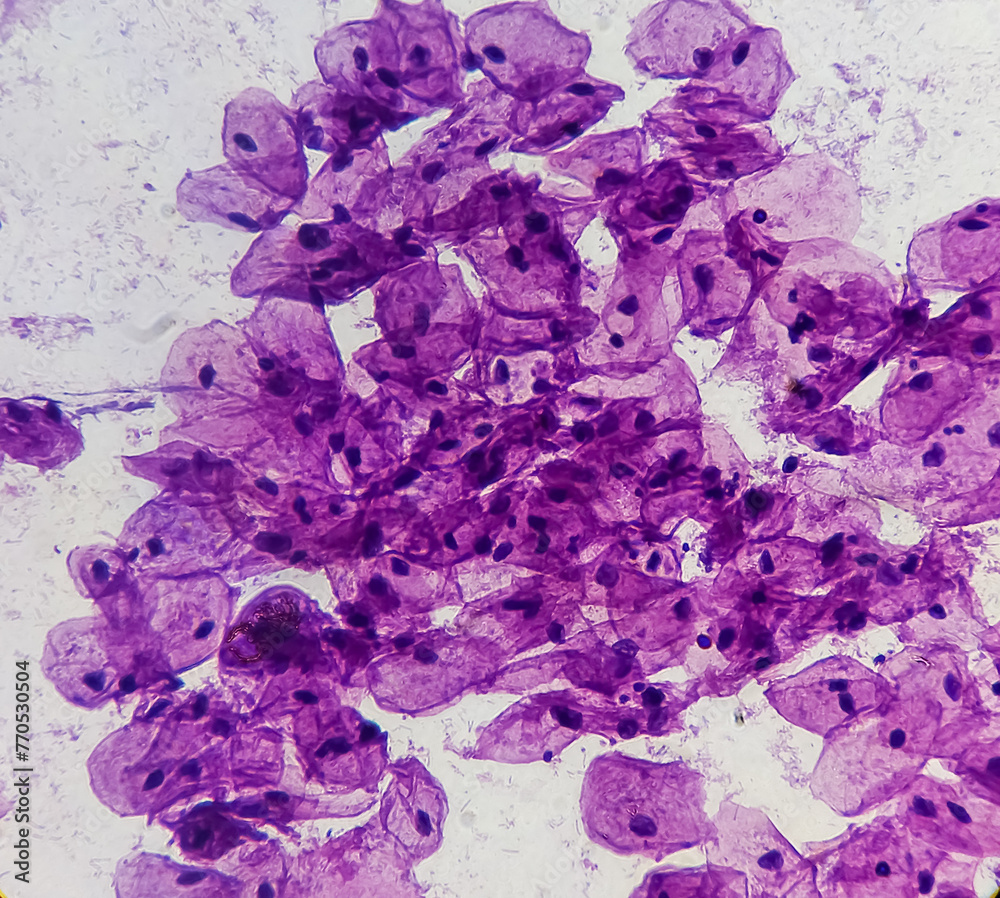 Light micrograph of a vaginal smear showing adenocarcinoma cells ...