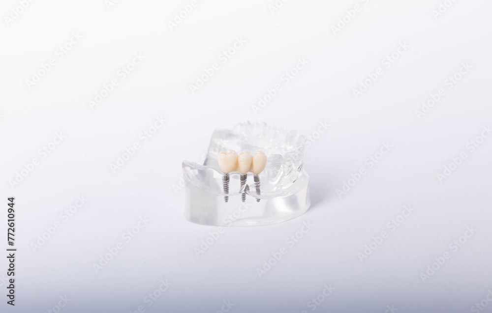 render of mandibular prosthesis all on 4 system supported by implants ...