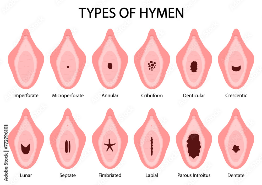 Different Types of Hymen shapes. Parous introitus Microperforate Lunar Septate Fimbriated Labial ...