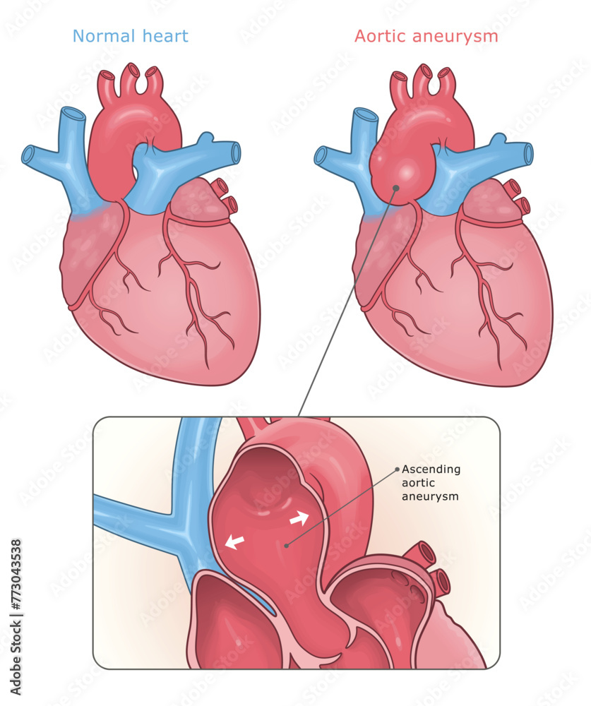 Normal heart and heart with ascending aortic aneurysm vector medical ...