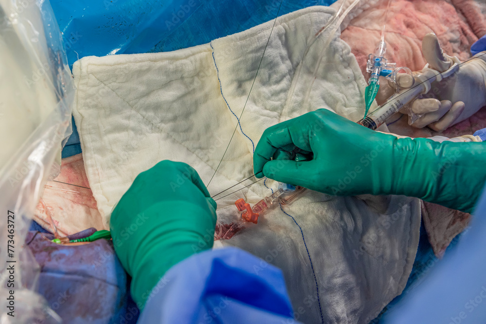 Heart stent placement process in operating room. Heart doctor inserting ...