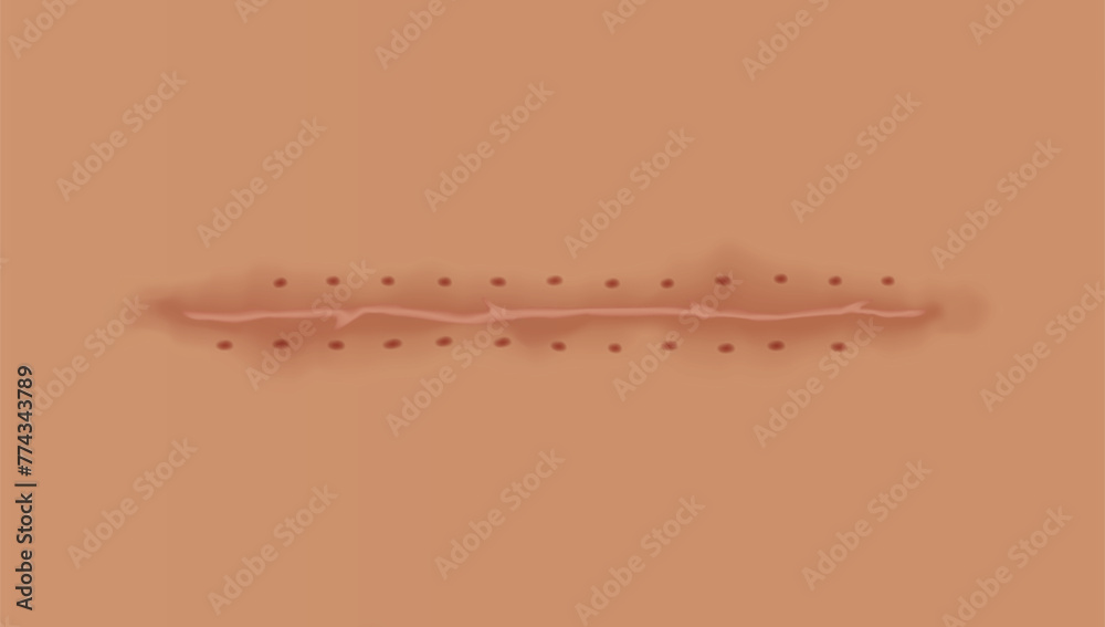 Healing wounds, skin scar, stitched gash and cut. Realistic surgical ...