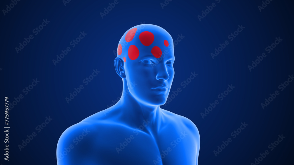 Types of Headache (Ice pick) 3d illustration Stock Illustration | Adobe ...