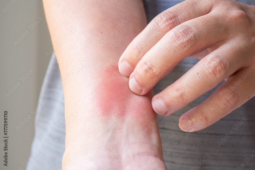 Young asian man itching and scratching on arm from allergic itchy dry ...
