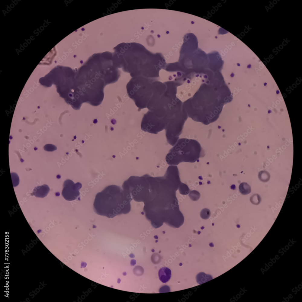 Cold agglutinins disease, RBCs to clump together (agglutinate) at low ...