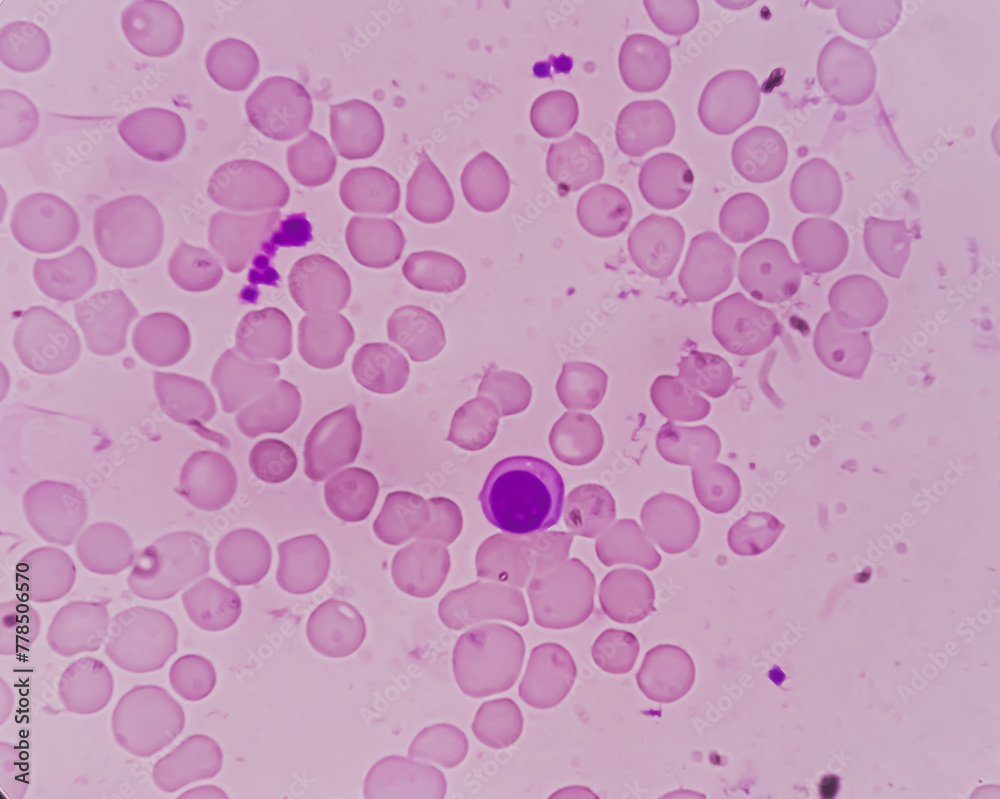 Blood smear show anisocytosis and target cells, Macrocytic anemia ...