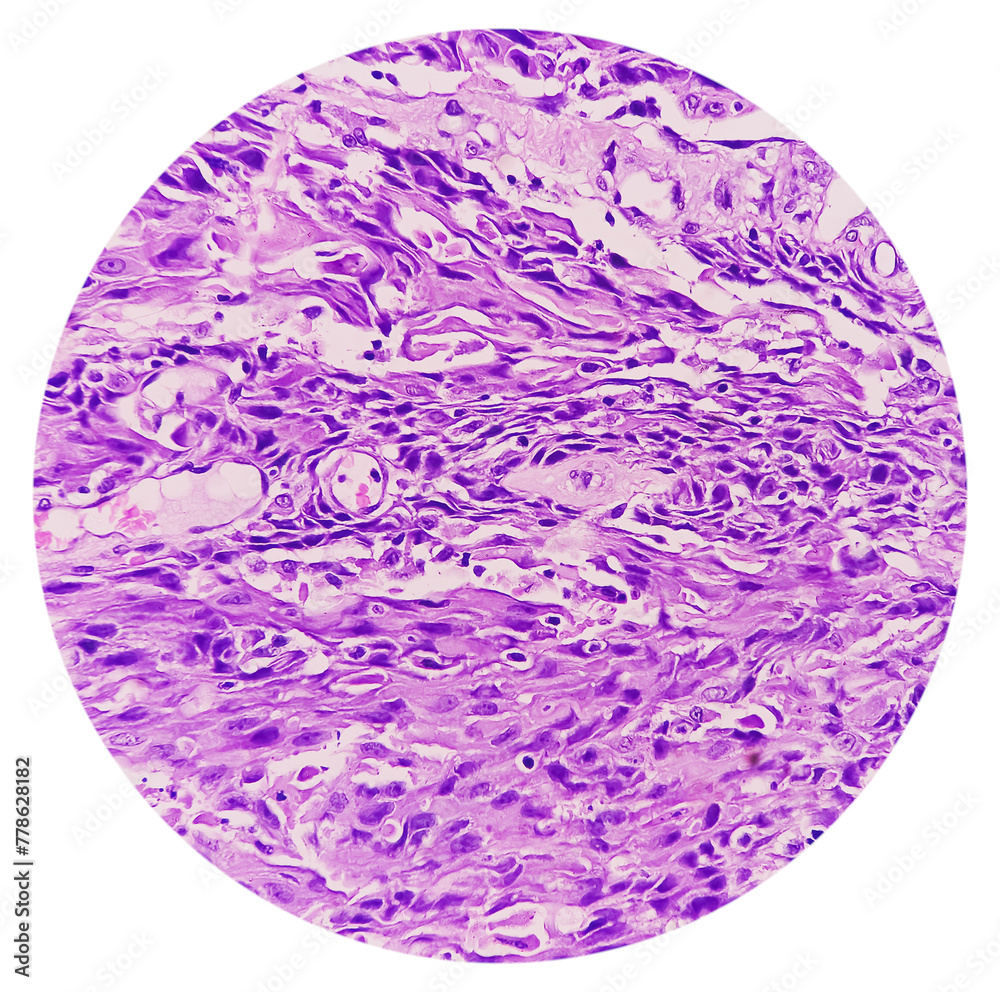 Photomicrograph of Rectal cancer. IBD. IBS. Squamous cell carcinoma of ...