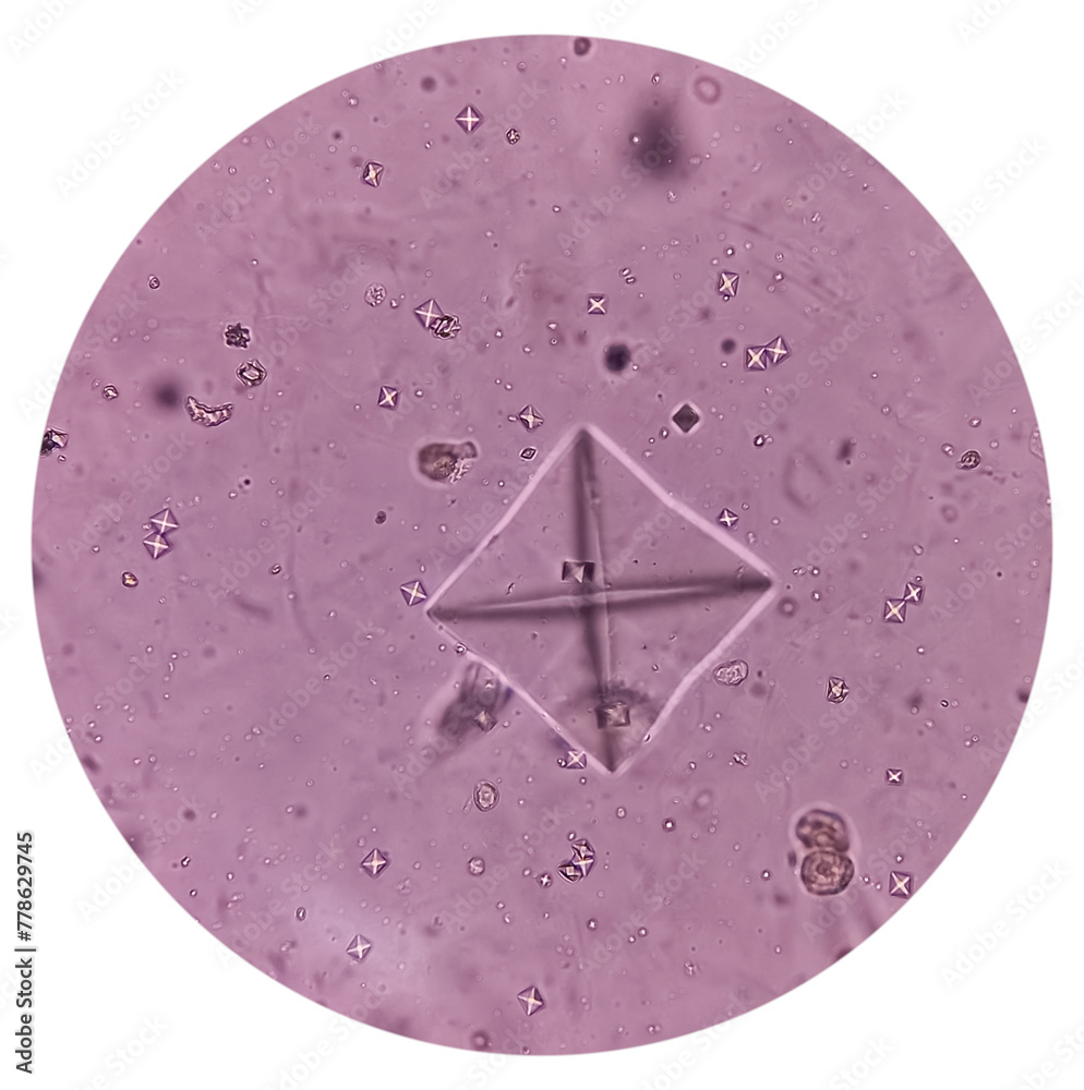 Microscopic image showing many calcium oxalate crystals from urine ...