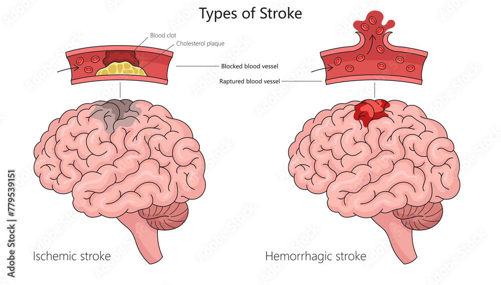 Human ischemic stroke and hemorrhagic stroke in human brain anatomy ...