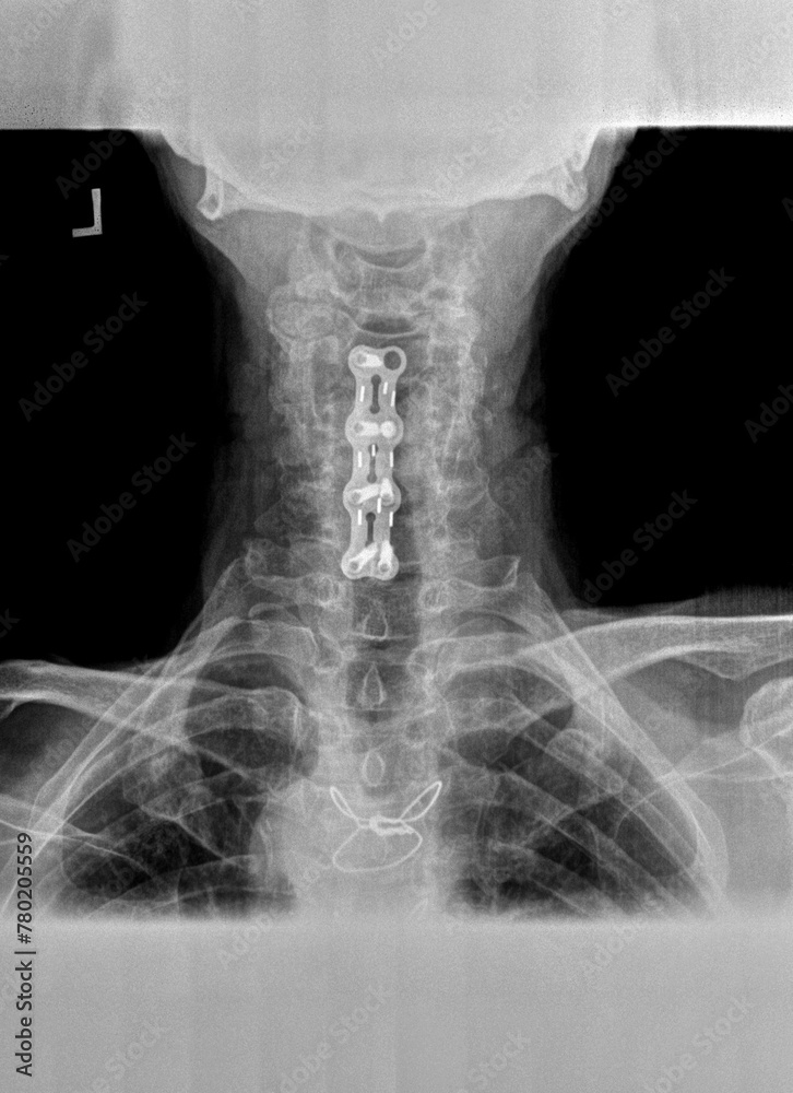 Film xray or radiograph of a cervical neck. AP anterior posterior view ...