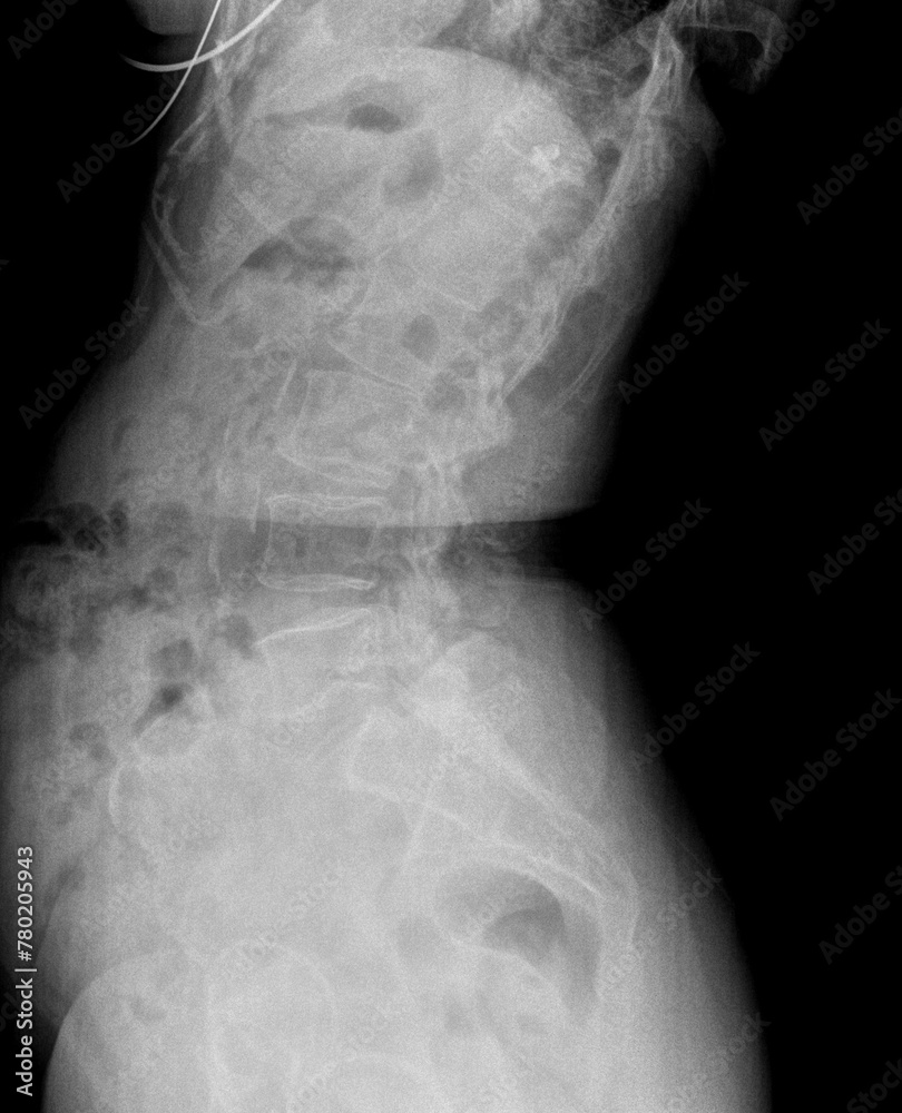 Film xray or radiograph of lumbar low back vertebrae showing pencil ...