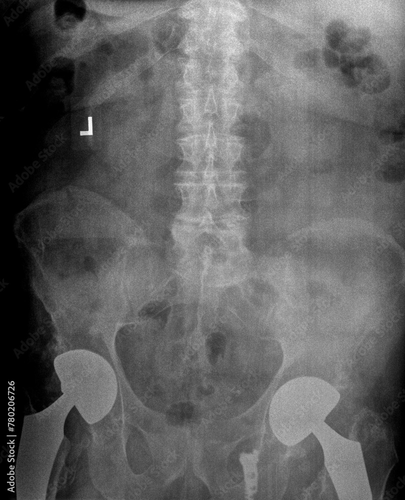 Film xray or radiograph of a lumbar spine, pelvis and hip. AP anterior ...