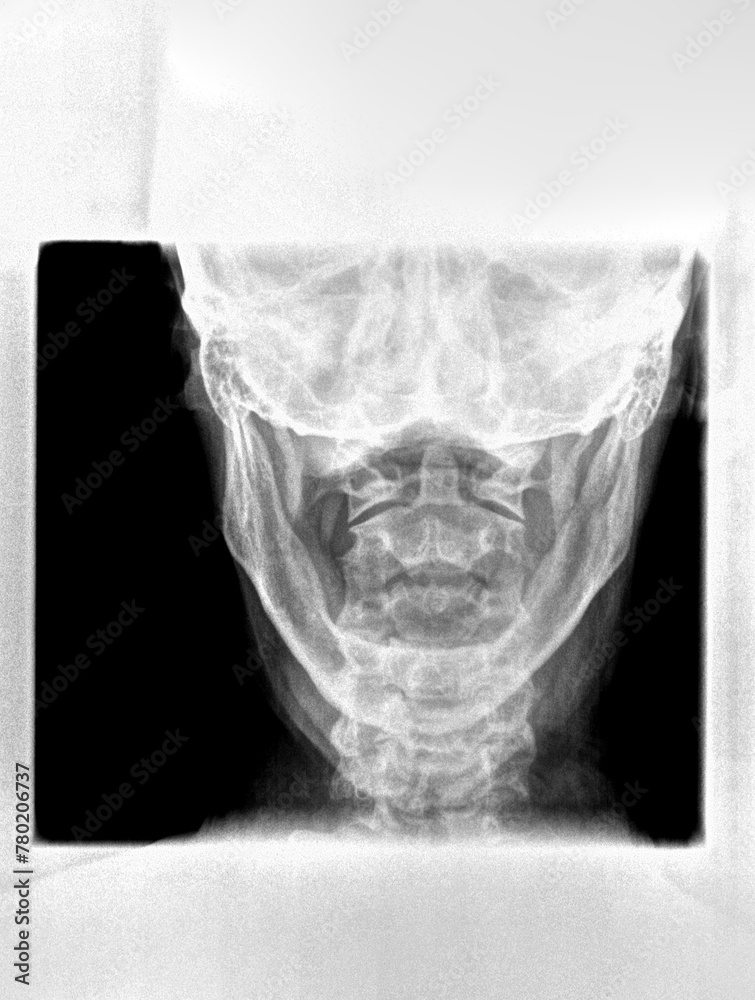 Film xray or radiograph of a cervical neck. AP open mouth anterior ...