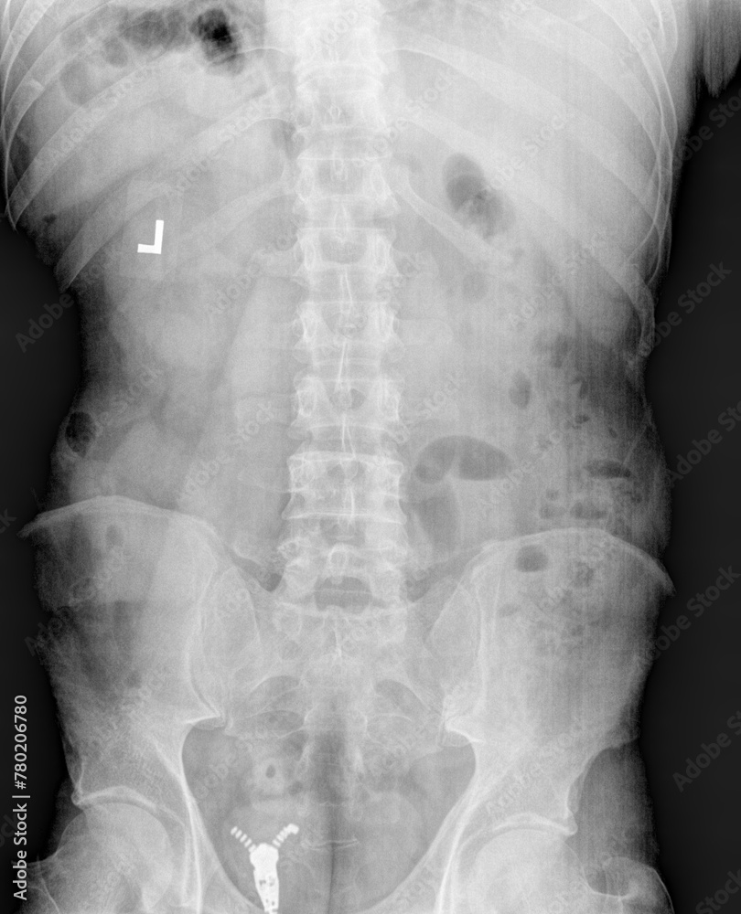 Film x ray or radiograph of a normal adult lumbar vertebrae anterior ...