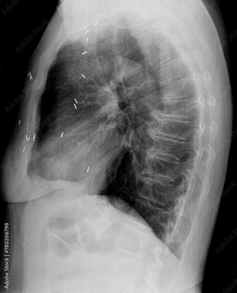 Film xray or radiograph of a mid back thoracic vertebrae . Lateral side ...
