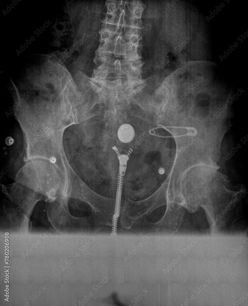 Film x ray or radiograph of a normal adult lumbar vertebrae anterior ...