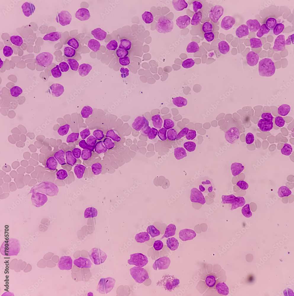 Acute leukemia, ALL(Acute lymphoblastic leukemia), peripheral blood ...