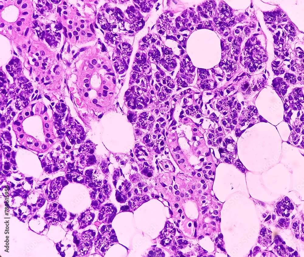 Salivary mucoid cyst. microscopic show parotid tissue, features of cyst ...