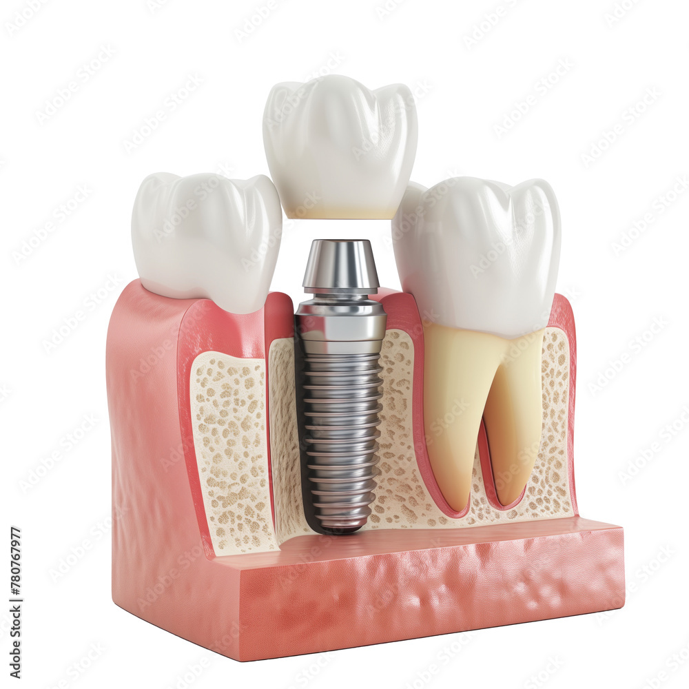 Detailed dental implant model showcasing a cross-section of a tooth ...