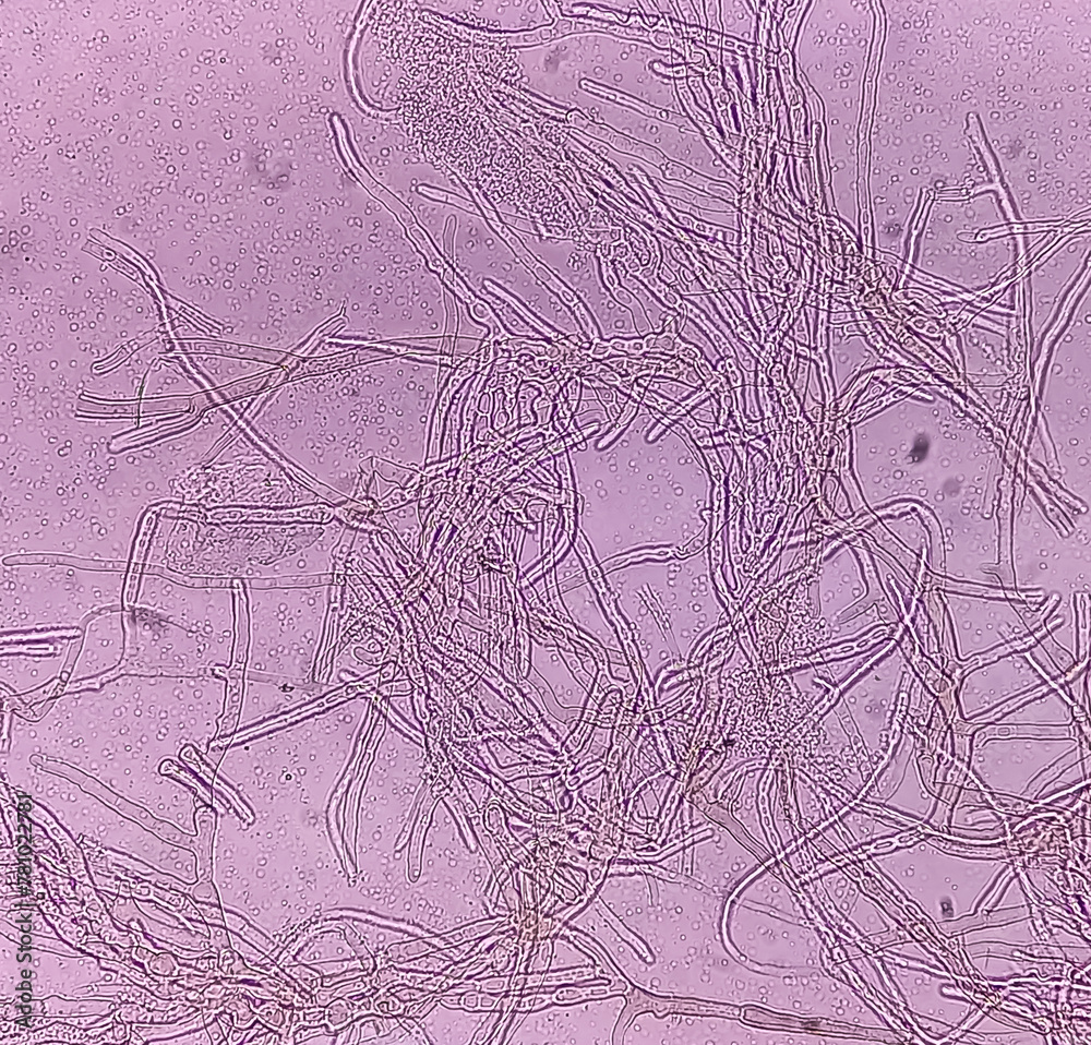 Microscopic fungi Malassezia furfur, showing yeast cells and hyphae ...