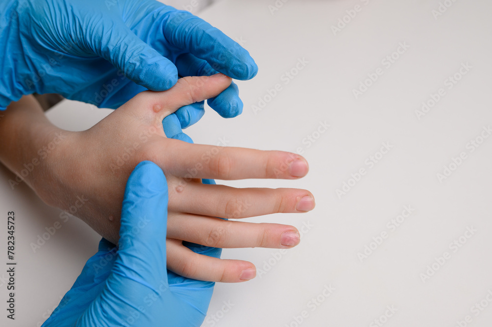 Doctor examines a child hand affected by viral warts Verruca vulgaris ...