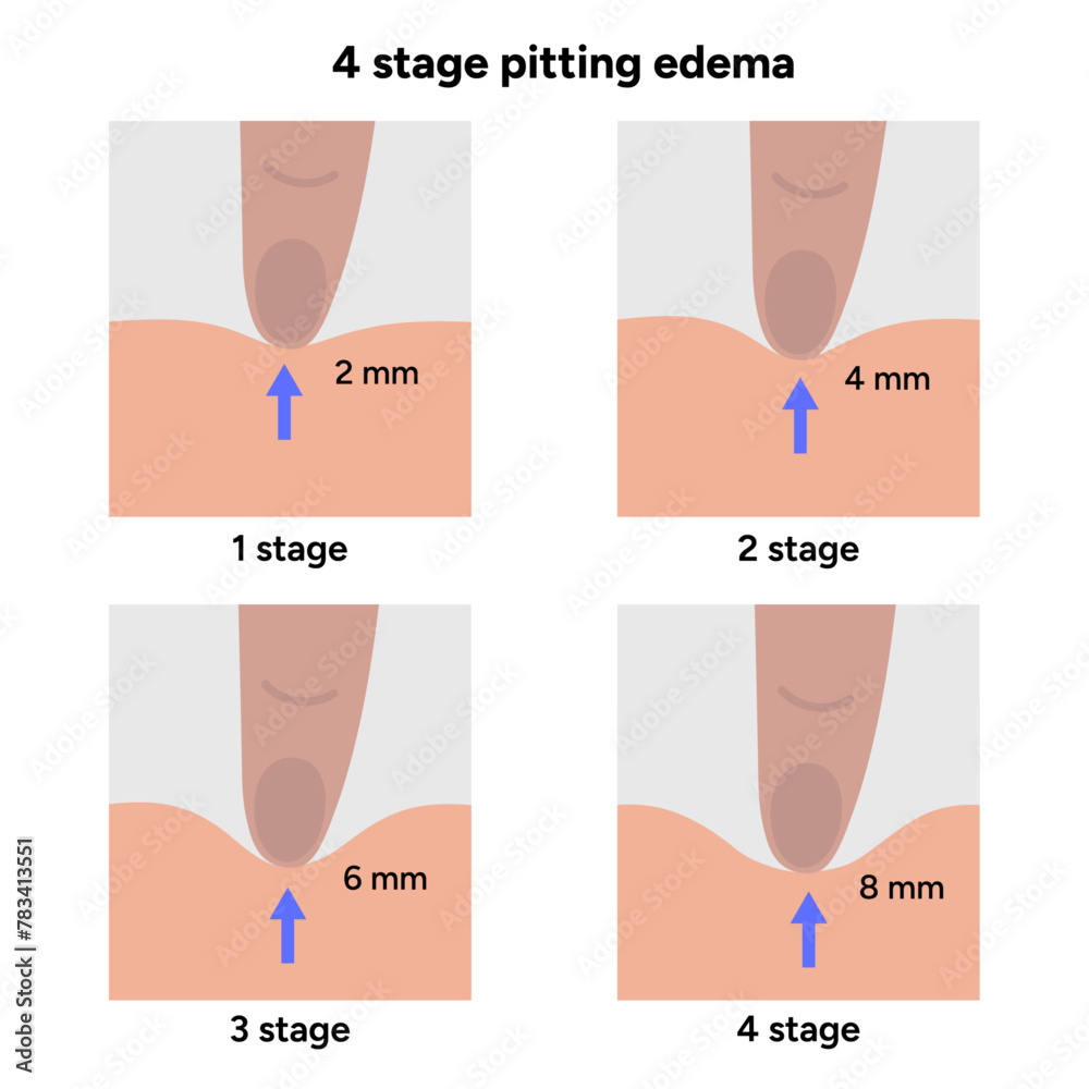 Edema swollen foot, medical infographic, 4 stages of edema Stock Vector ...