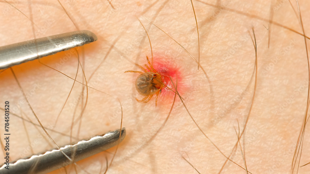 Close-up of tick embedded in human skin being removed with tweezers ...