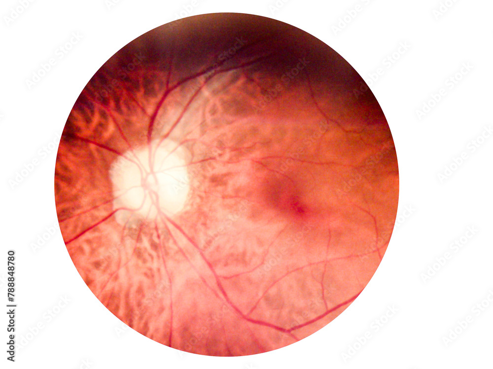 Patient elderly with retina of diabetes.Human eye anatomy taking images ...