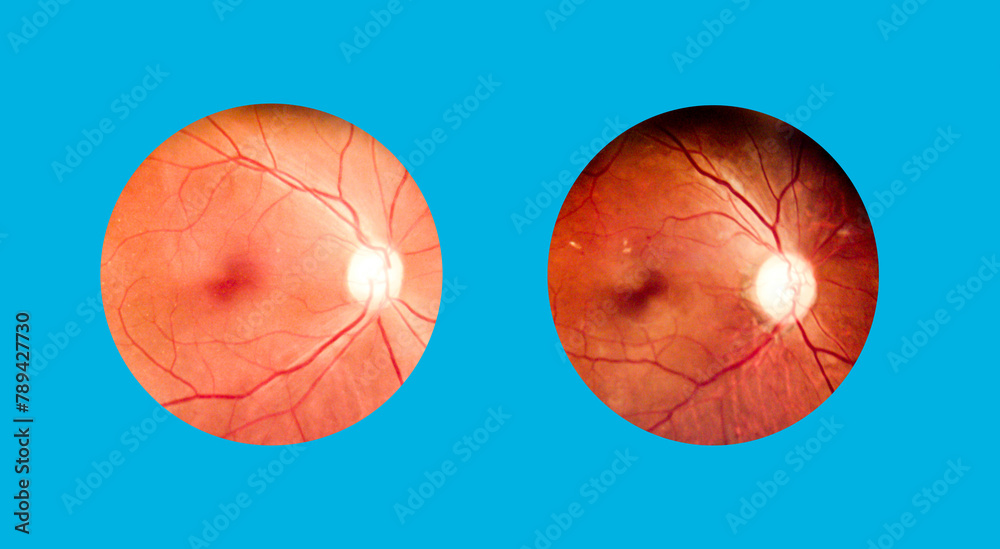 Patient elderly with retina of diabetes.Human eye anatomy taking images ...