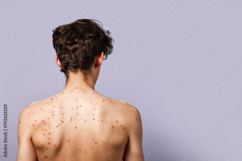 Male Back with Painful Rash, Red Spots Blisters on the Skin. Human Body ...