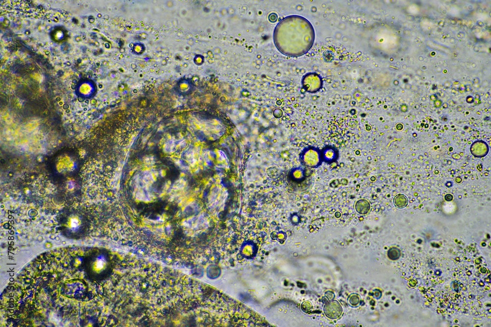 Coughing up mucus and phlegm from a chest infection from a virus and ...