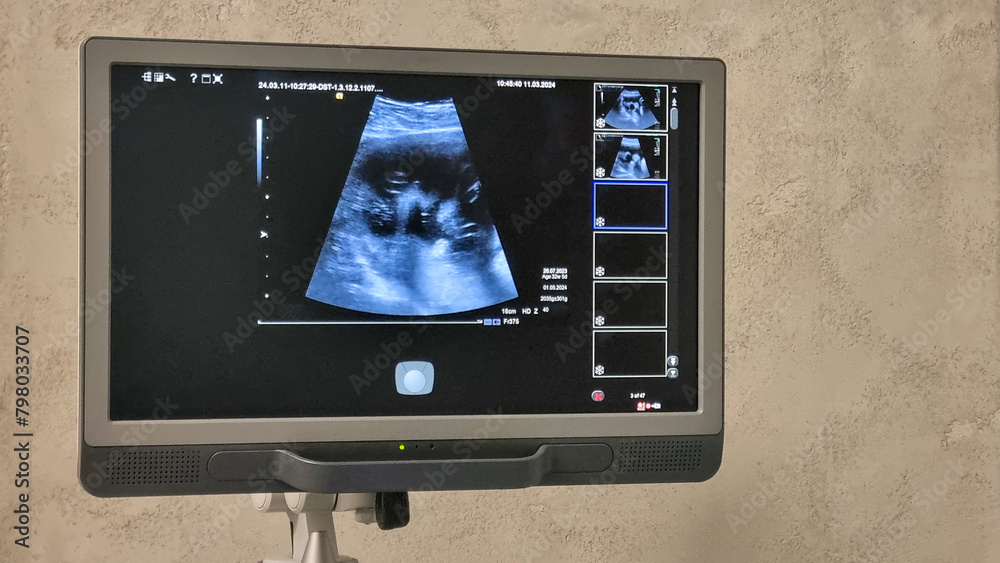 ultrasound monitor with fetus pictures, ultrasound equipment with baby ...