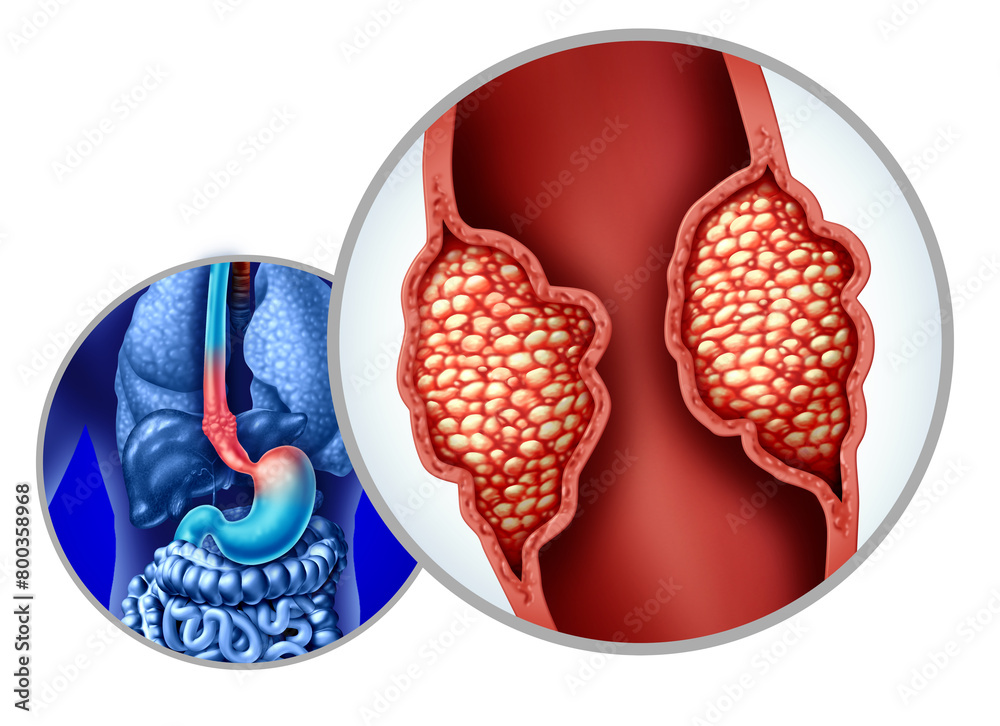 Esophageal Cancer or esophagus Carcinoma as Adenocarcinoma mutating ...