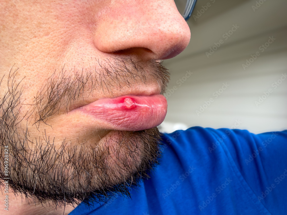 Painful big aphthous ulcer or canker sores disease on the lip, side ...
