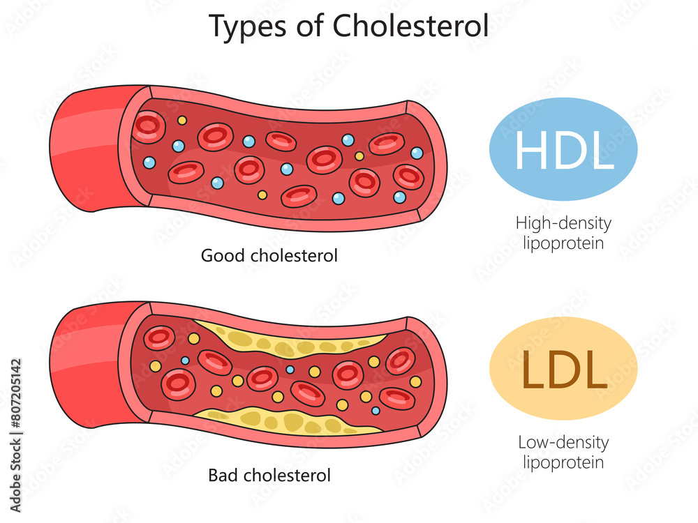 HDL (good) cholesterol and LDL (bad) cholesterol in blood vessels for health education diagram ...