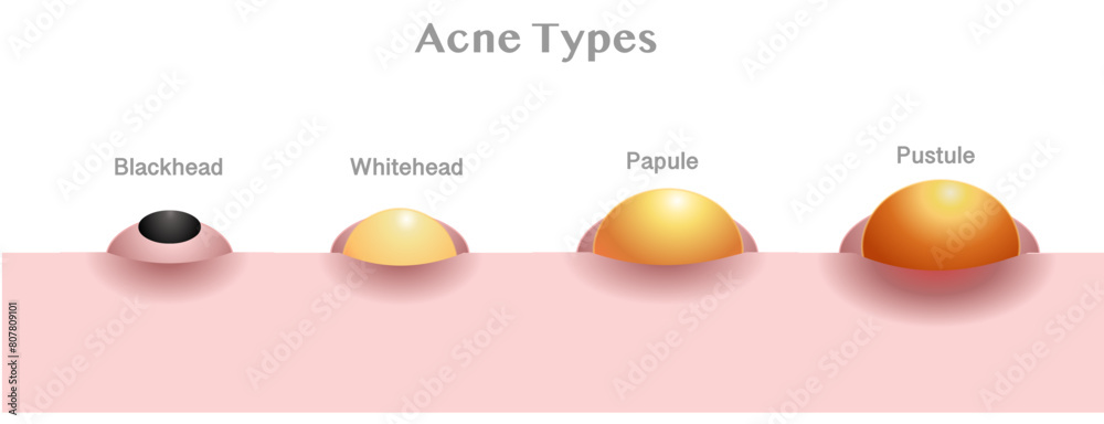 Vector de Stock Acne type anatomy, diagram. Skin side view, blackhead ...
