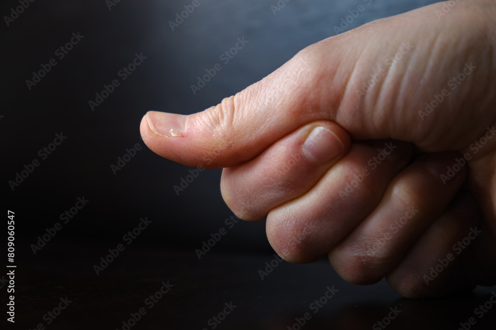 Bleeding hangnail of a female hand on dark background close-up. Ill ...