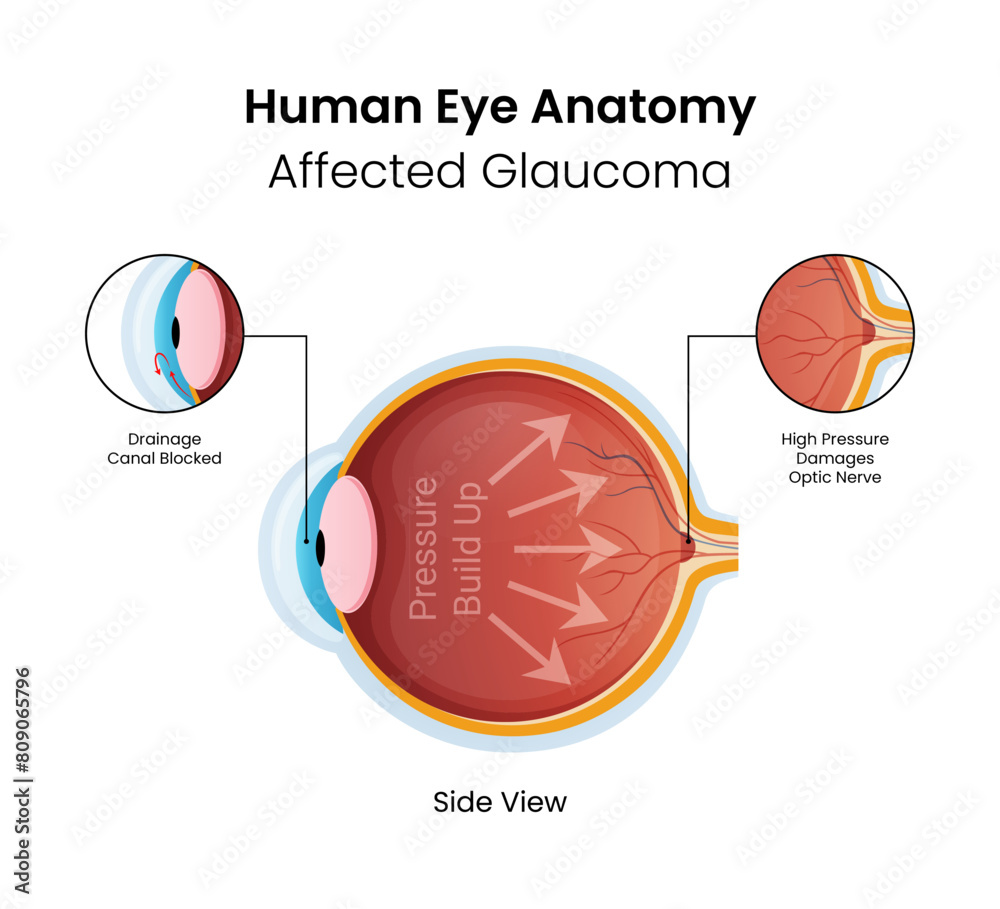 human eye anatomy affected glaucoma Stock Vector | Adobe Stock