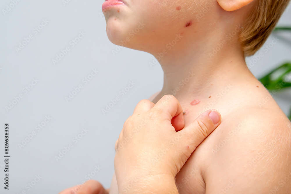 Stock-Foto „Little boy scratching himself,rash on child body,Chickenpox ...