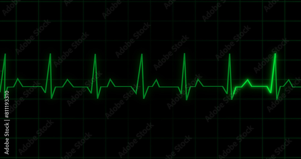 EKG Heartbeat reading animation on black background. Medical monitor ...