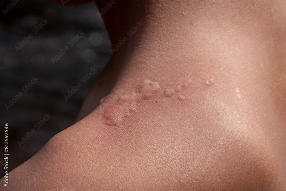 Rash caused by insect bites on skin shoulder,Itchy rash caused by water ...