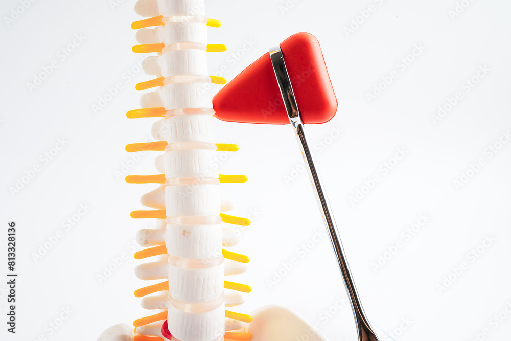 Spinal nerve and bone with knee reflex hammer, Lumbar spine displaced ...