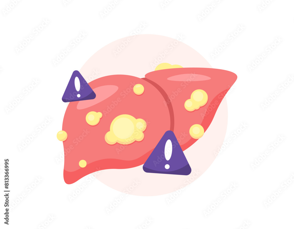 illustration of a liver organ full of fat. Fatty liver disease or ...