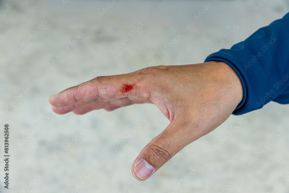 Dog bite wound and blood on hand. Infection and Rabies concept. Pet ...