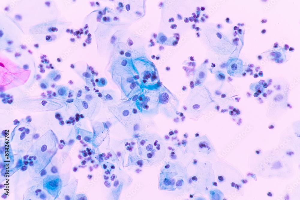 Abnormal squamous epithelial cells view in microscopy.HPV criteria for ...