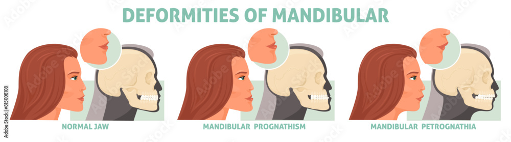 Female jaw deformities of mandibular medical poster vector illustration ...