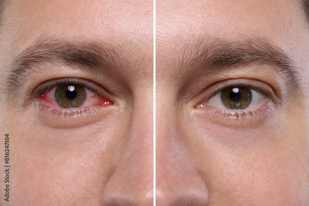 Before and after conjunctivitis treatment. Photos of man with red and ...